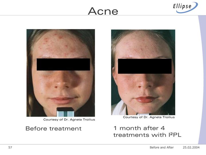 Acne Treatment Leamington Spa