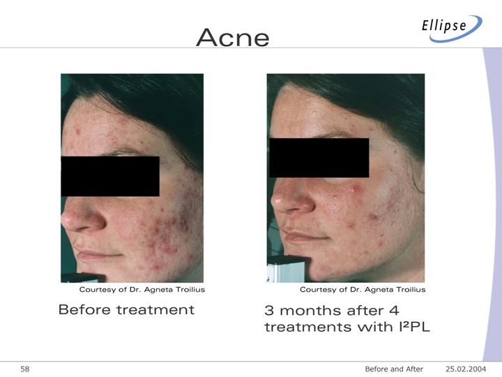 Acne Treatment Leamington Spa